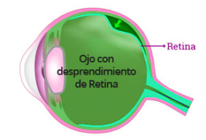 Desprendimiento de retina - Visum
